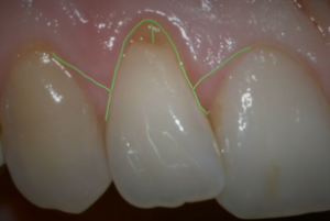 Coronally positioned flap without releasing incisions – DentalmedTV