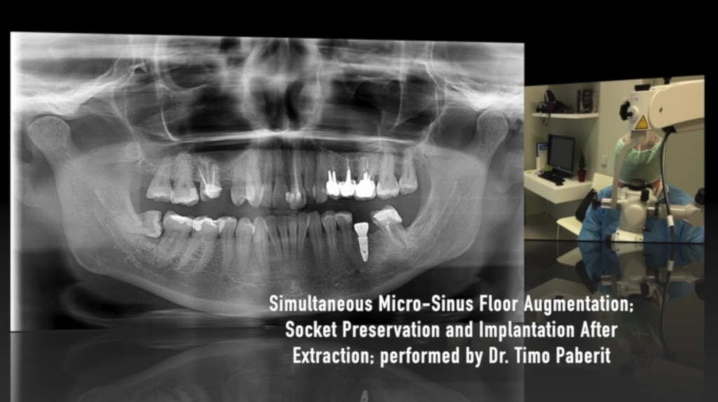 Simultaneous micro-sinus floor augmentation: socket preservation and ...